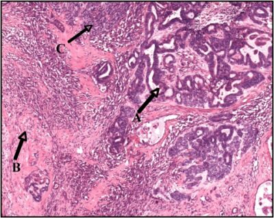 Wilms Tumor | Concise Medical Knowledge