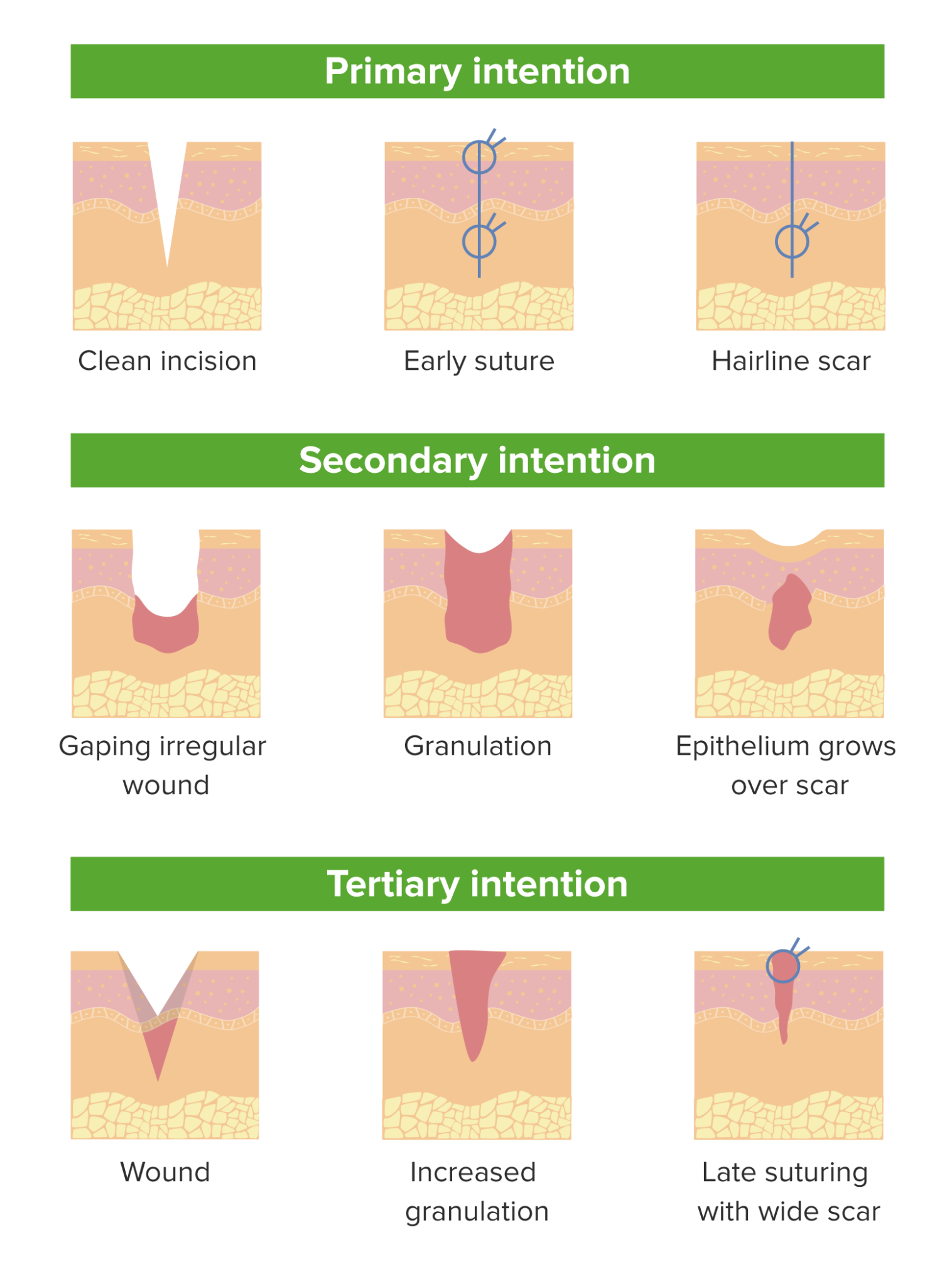 Wound Healing | Concise Medical Knowledge