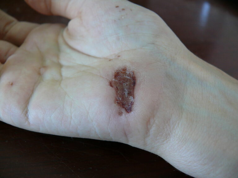 Wound Healing | Concise Medical Knowledge