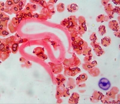 Lymphatic Filariasis (Elephantiasis) | Concise Medical Knowledge