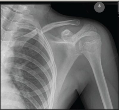 Clavicle Fracture | Concise Medical Knowledge