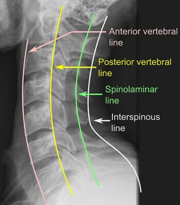 Imaging of the Spine and Spinal Cord | Concise Medical Knowledge