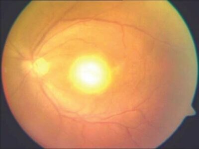 Chorioretinitis | Concise Medical Knowledge