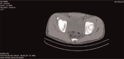 Apophyseal Avulsion Fracture | Concise Medical Knowledge