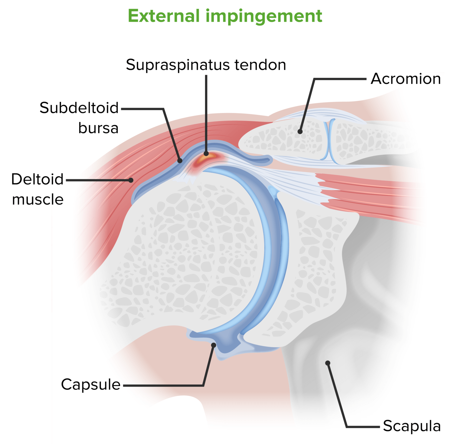 Chronic Shoulder Pain | Concise Medical Knowledge