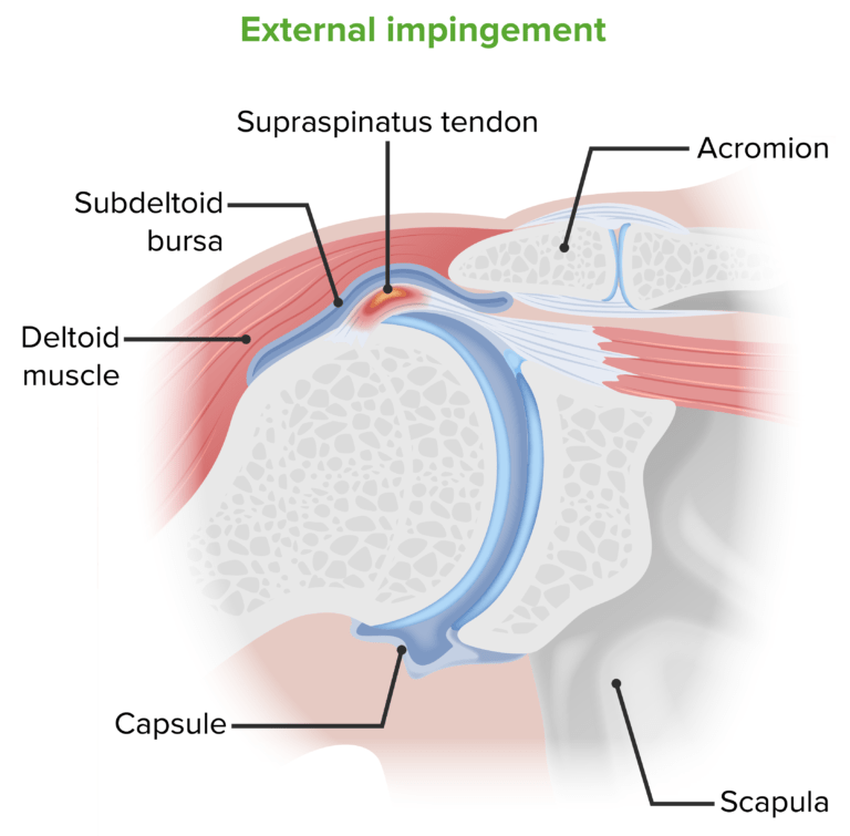 Chronic Shoulder Pain | Concise Medical Knowledge