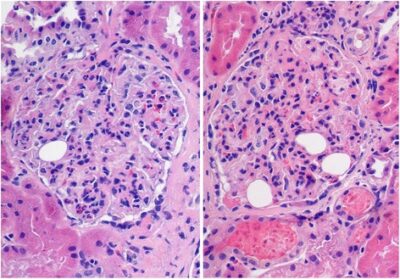 Diffuse Proliferative Glomerulonephritis | Concise Medical Knowledge