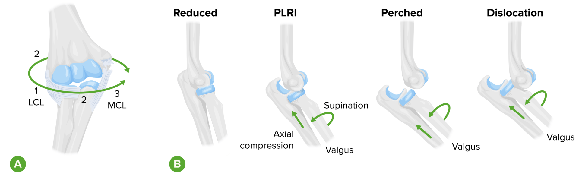 Luxación del Codo | Concise Medical Knowledge