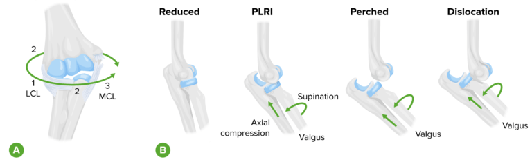 Elbow Dislocation | Concise Medical Knowledge