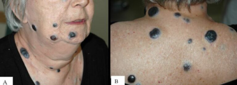 Melanoma | Concise Medical Knowledge