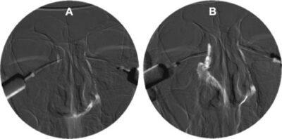 Dacryocystitis | Concise Medical Knowledge