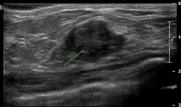 Ultrasonido (Ecografía) | Concise Medical Knowledge