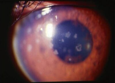 Ophthalmic Exam | Concise Medical Knowledge