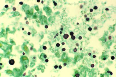 Cryptococcus/Cryptococcosis | Concise Medical Knowledge