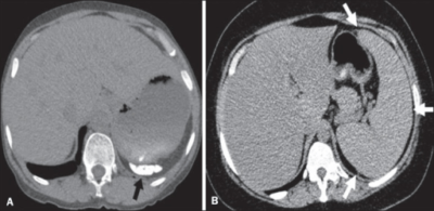 Sickle Cell Disease | Concise Medical Knowledge
