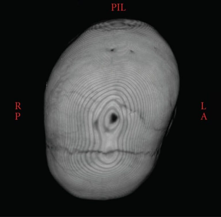 Craniossinostose | Concise Medical Knowledge